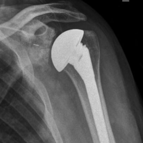 Shoulder Surgery | Surgeons & Physicians | Ballarat OSM